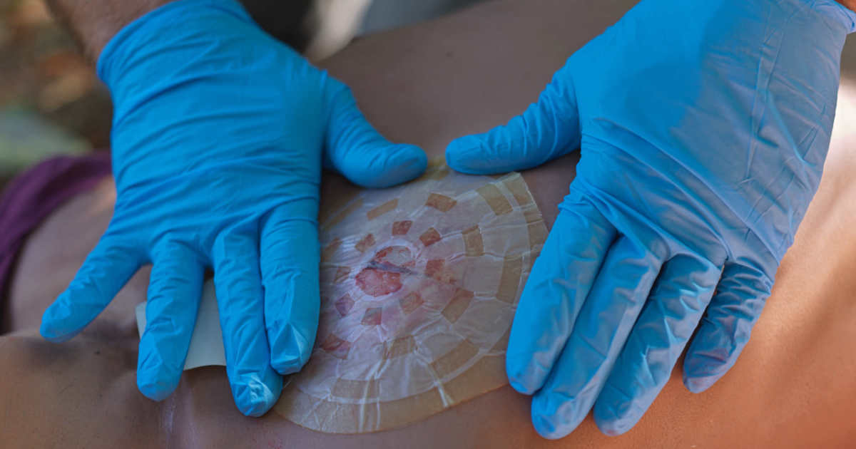 Chest Seal and Tourniquet application: ExR